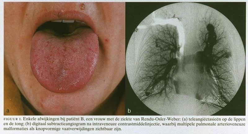 Recidiverende epistaxis: soms de ziekte van Rendu-Osler-Weber ...