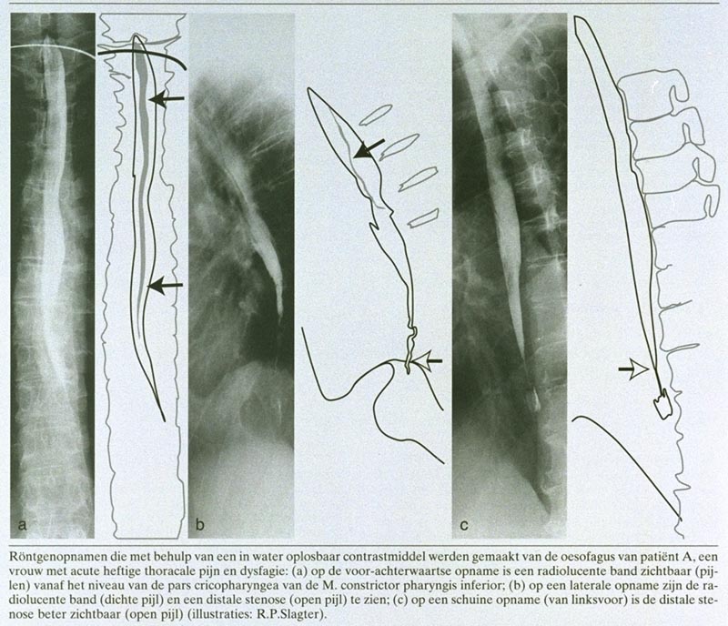 Acute passageklachten veroorzaakt door een spontane intramurale ruptuur ...