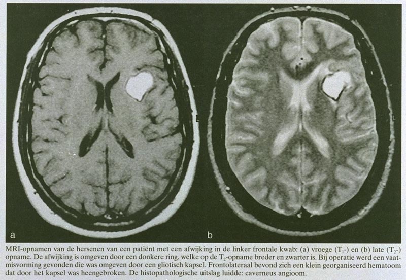 Caverneus angioom in de hersenen; de indicatie voor neurochirurgische ...
