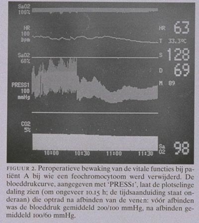 Feochromocytoom als oorzaak van collaps en hypertensie tijdens een ...