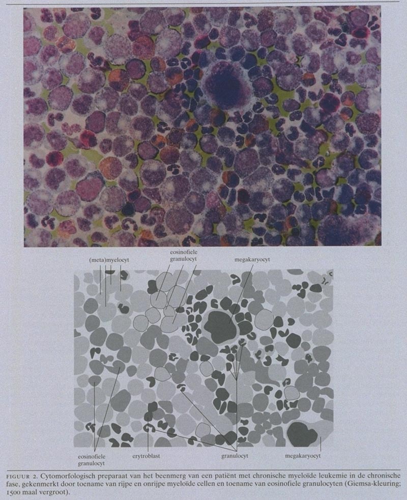 Ontwikkelingen in de behandeling van patiënten met chronische myeloïde ...