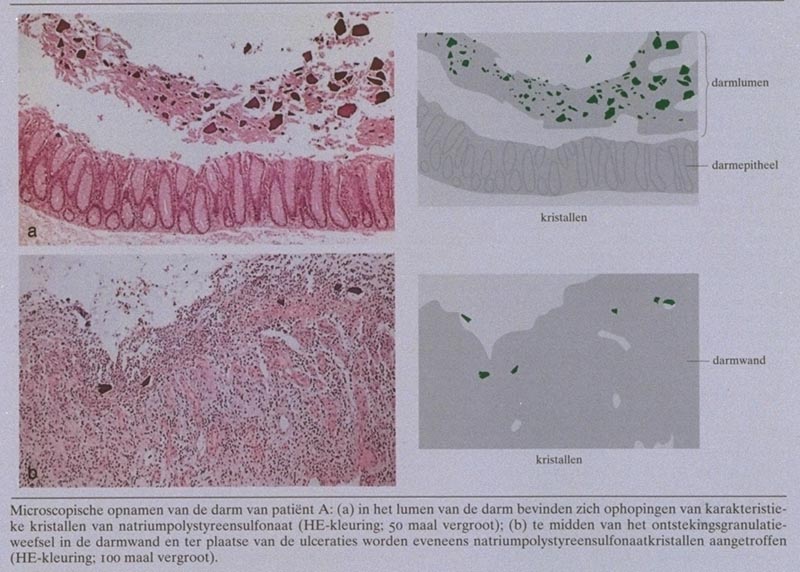 Natriumpolystyreensulfonaat (Resonium A) als mogelijke oorzaak van ...