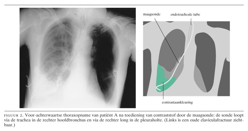 Iatrogene spanningspneumothorax na verkeerd geplaatste maagsonde ...
