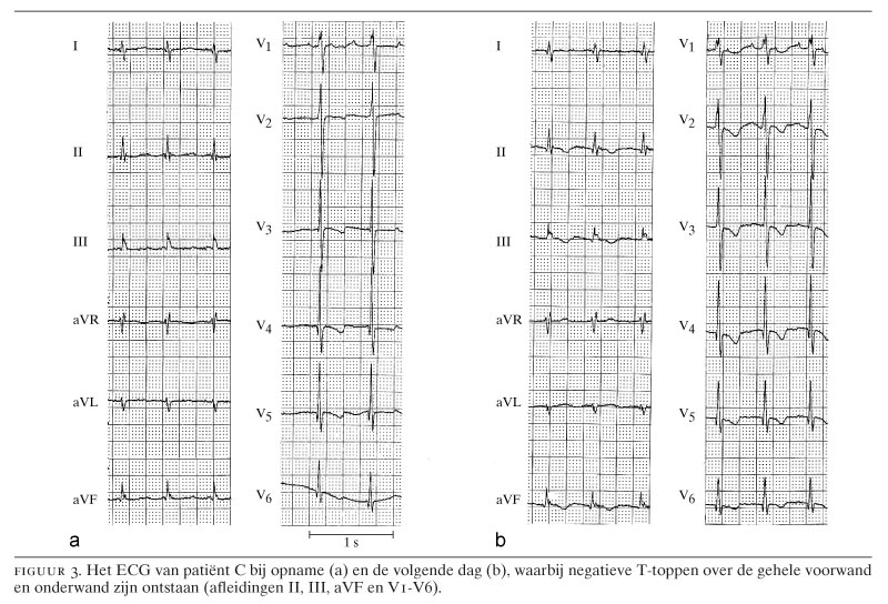 Pijn op de borst en afwijkend elektrocardiogram: denk aan longembolie ...