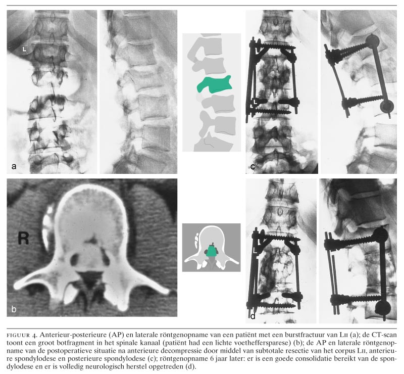 Honderd jaar orthopedie in Nederland. IV. Wervelkolomaandoeningen ...