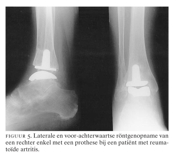 Honderd jaar orthopedie in Nederland. VI. Reumachirurgie | Nederlands ...