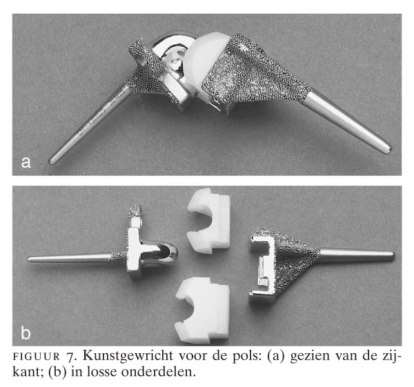 Prothesen van de bovenste extremiteit | Nederlands Tijdschrift voor ...