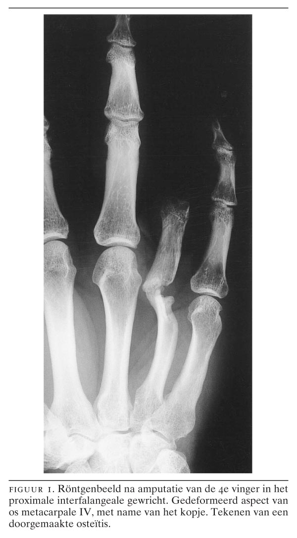 Hand-tandletsel: onderschat het niet | NTVG