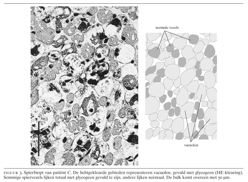 Drie hypotone zuigelingen met een hypertrofische cardiomyopathie: de ...