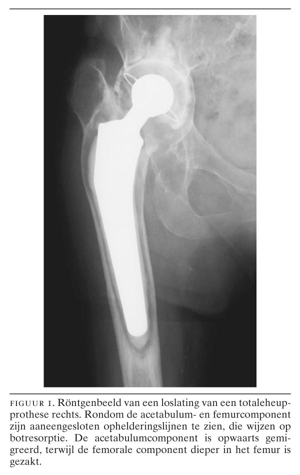 Operatieve technieken bij het reviseren van heupprothesen | NTVG