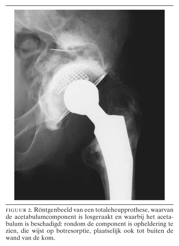 Operatieve technieken bij het reviseren van heupprothesen | NTVG