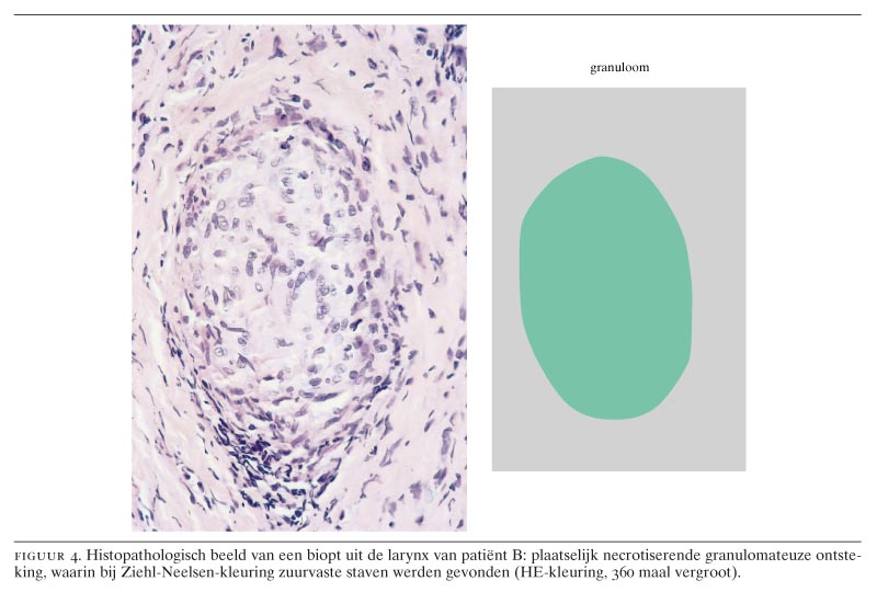 Tuberculose in de larynx | Nederlands Tijdschrift voor Geneeskunde