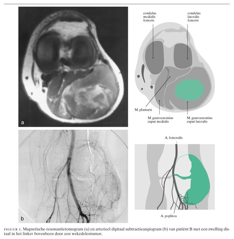 Een zwelling distaal in het bovenbeen | NTVG