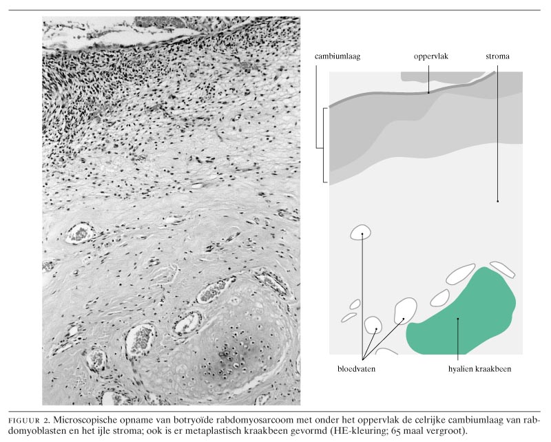 Een zeldzame oorzaak van fluor vaginalis: sarcoma botryoides | NTvG