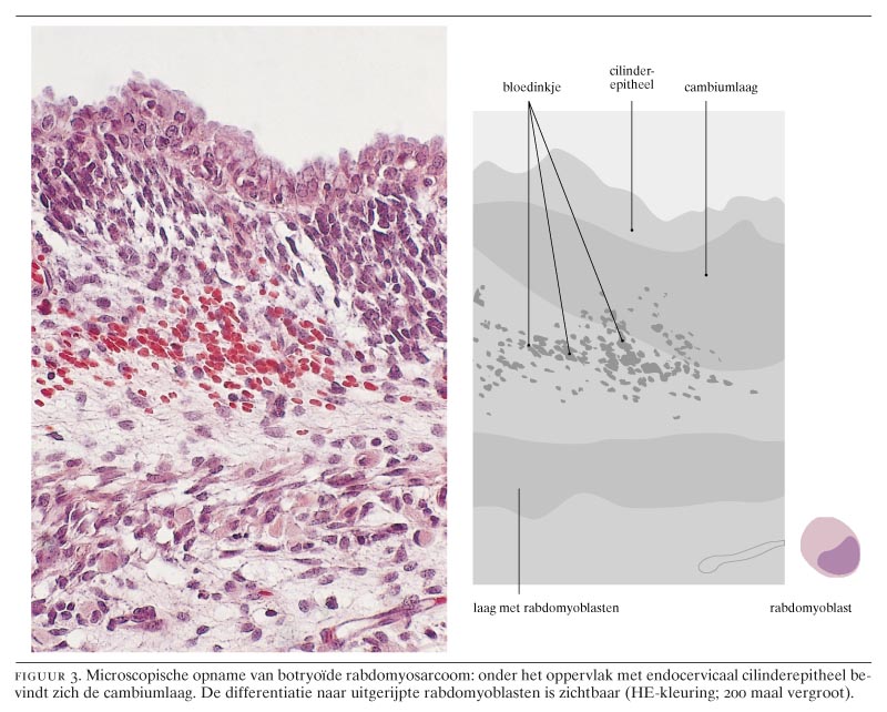 Een zeldzame oorzaak van fluor vaginalis: sarcoma botryoides ...
