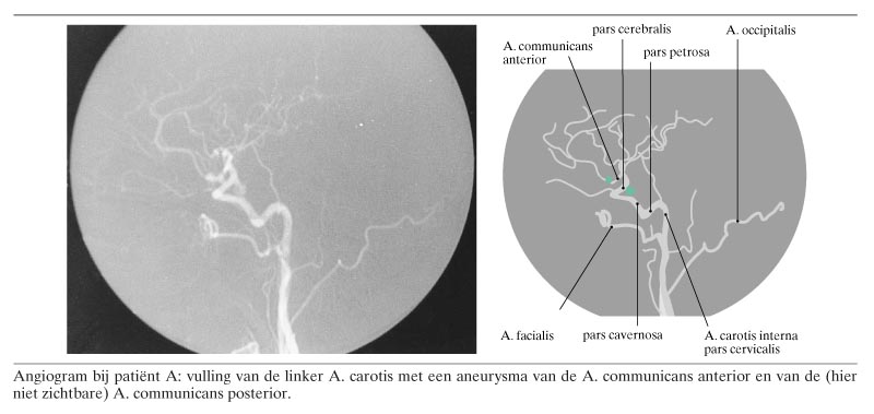 Dubbelzien als symptoom van een ernstige aandoening | NTVG