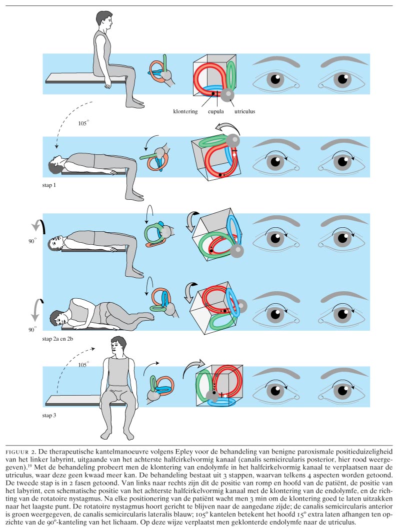 Benigne paroxismale positieduizeligheid | Nederlands Tijdschrift voor ...