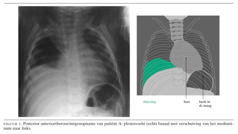 Klinisch denken en beslissen in de praktijk. Een kind met dyspneu en ...