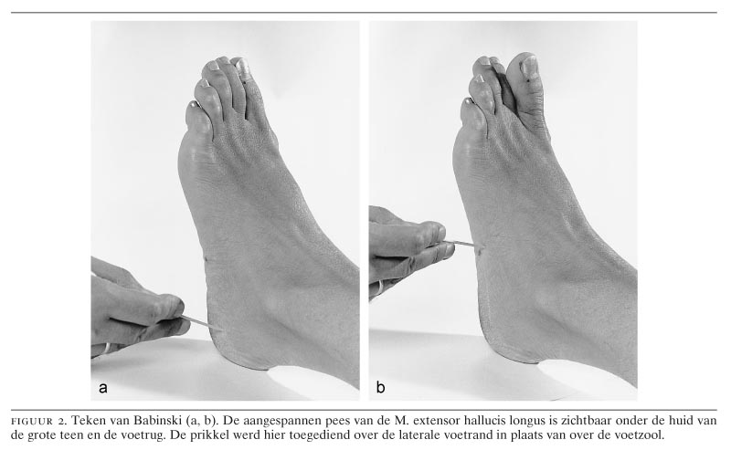 Fysische diagnostiek - de voetzoolreflex | NTVG