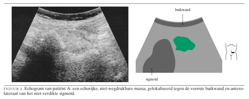 Appendicitis epiploica | NTVG