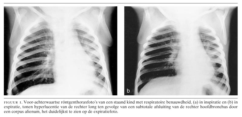Kind Met Epiglottitis Transcervical Epiglottopexy For Management Of