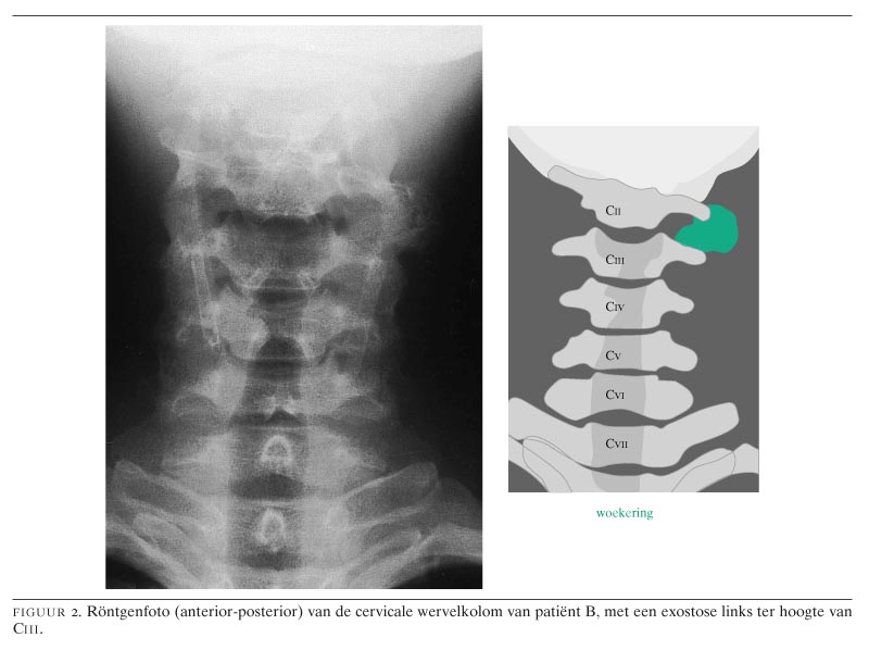 Twee patiënten met een osteochondroom van de cervicale wervelkolom ...