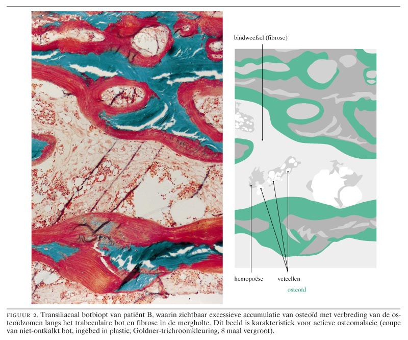 Ziek door te weinig zonlicht: rachitis en osteomalacie | Nederlands ...