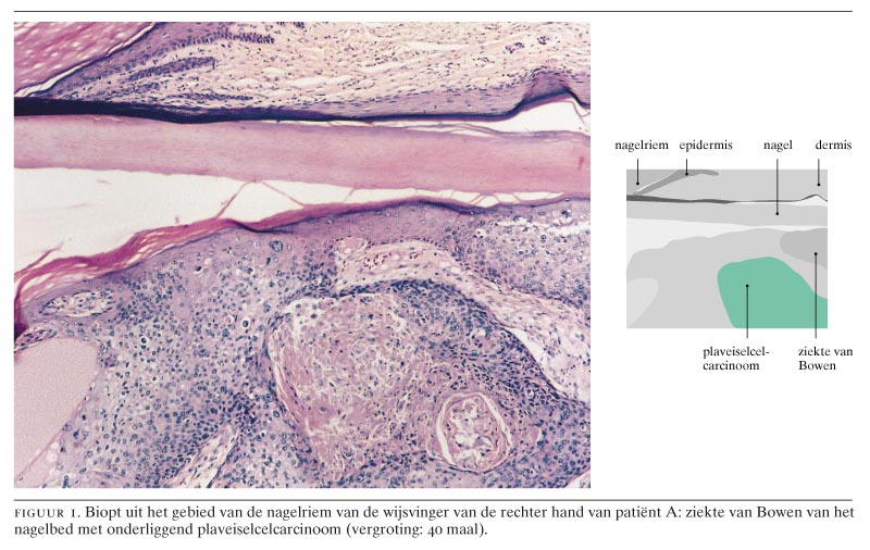Het plaveiselcelcarcinoom van het nagelbed | Nederlands Tijdschrift ...
