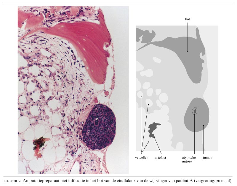 Het plaveiselcelcarcinoom van het nagelbed | Nederlands Tijdschrift ...