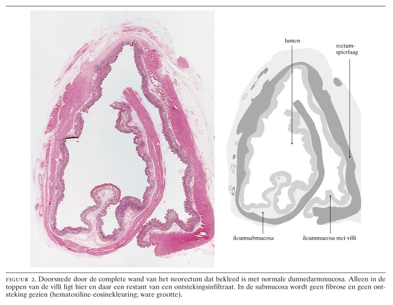 Operatieve behandeling van colitis ulcerosa en familiaire adenomateuze ...