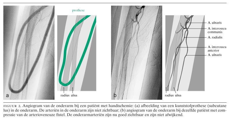 Arteriële doorbloedingsstoornissen van de hand bij 9 patiënten met een ...
