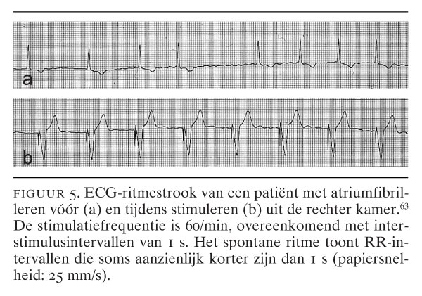Elektrofysiologie van de atrioventriculaire knoop tijdens ...