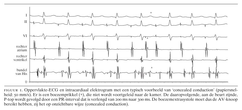 Elektrofysiologie van de atrioventriculaire knoop tijdens ...