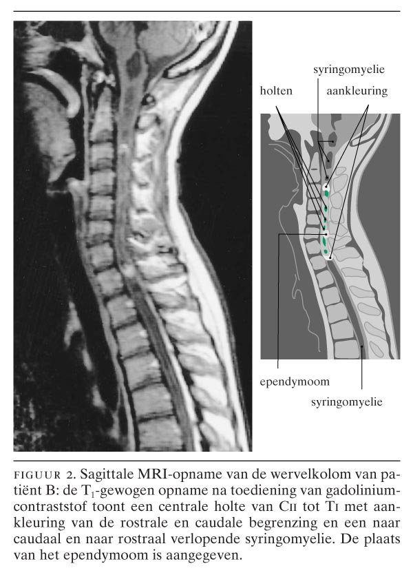 Prikkelingen in de handen | Nederlands Tijdschrift voor Geneeskunde