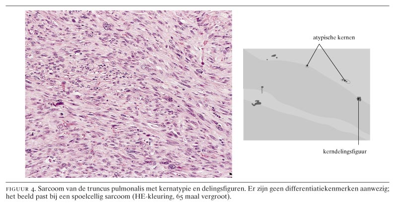 Primair sarcoom van de A. pulmonalis: zeldzame oorzaak van cor ...