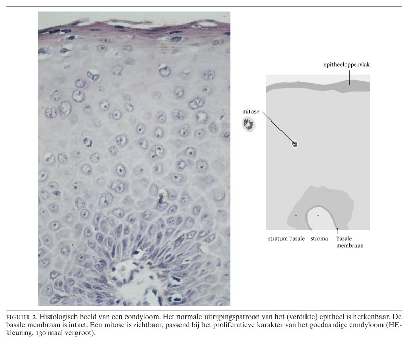 Condylomata acuminata: een zeldzaam symptoom van ubiquitair humaan ...