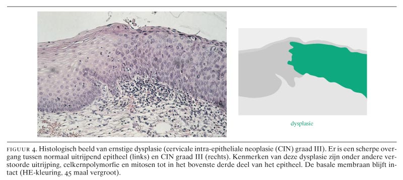 Condylomata acuminata: een zeldzaam symptoom van ubiquitair humaan ...