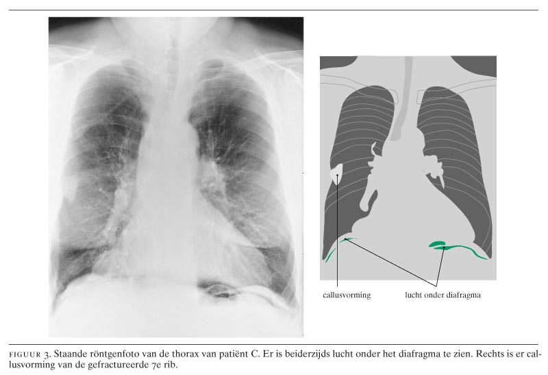 Vrije lucht onder het diafragma: niet altijd een acuut chirurgisch ...
