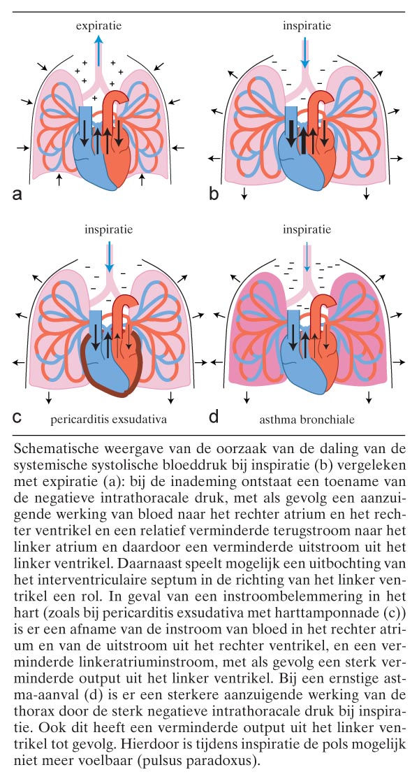 Fysische diagnostiek - pulsus paradoxus | Nederlands Tijdschrift voor ...
