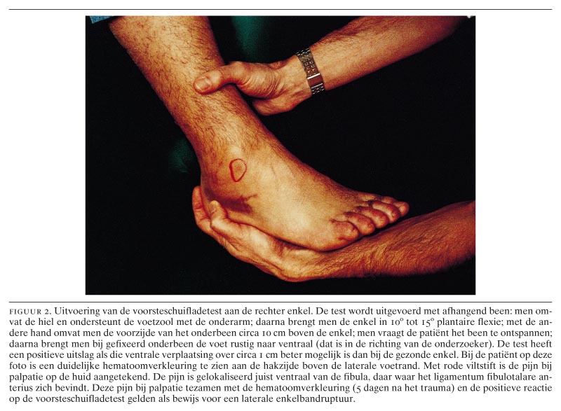 CBO-richtlijn voor diagnostiek en behandeling van het acute enkelletsel ...