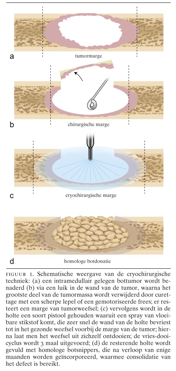 Gunstige effecten van cryochirurgische behandeling bij benigne en ...