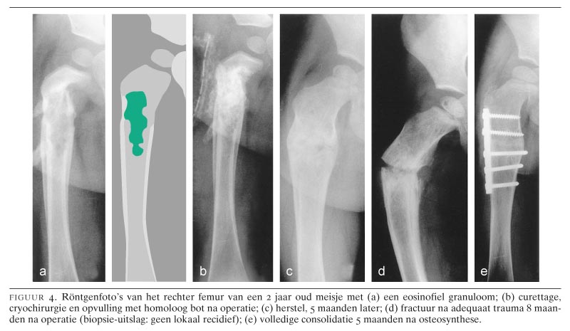 Gunstige effecten van cryochirurgische behandeling bij benigne en ...