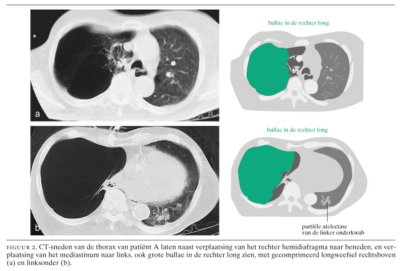 Dyspneu door bullae bij een chronisch intermitterend beademde patiënt ...