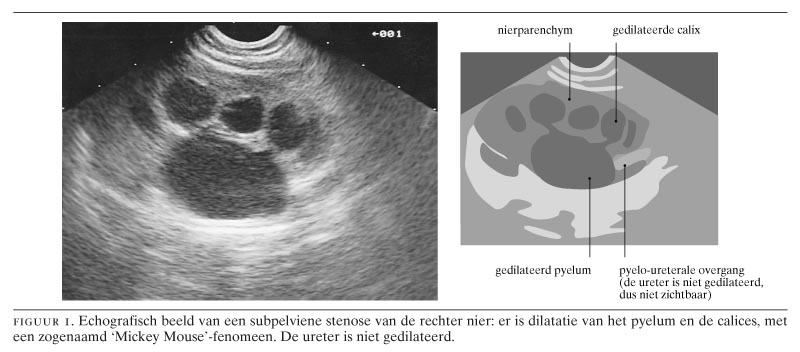 Asymptomatische dilatatie van het pyelocalicessysteem bij jonge ...