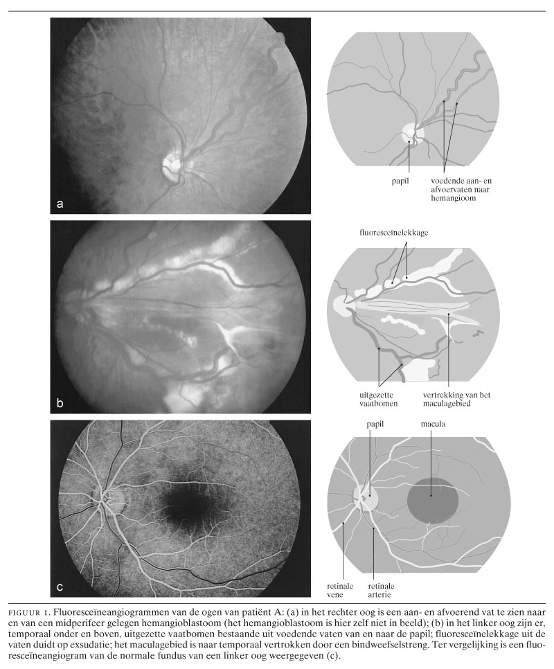 De ziekte van Von Hippel-Lindau | NTVG
