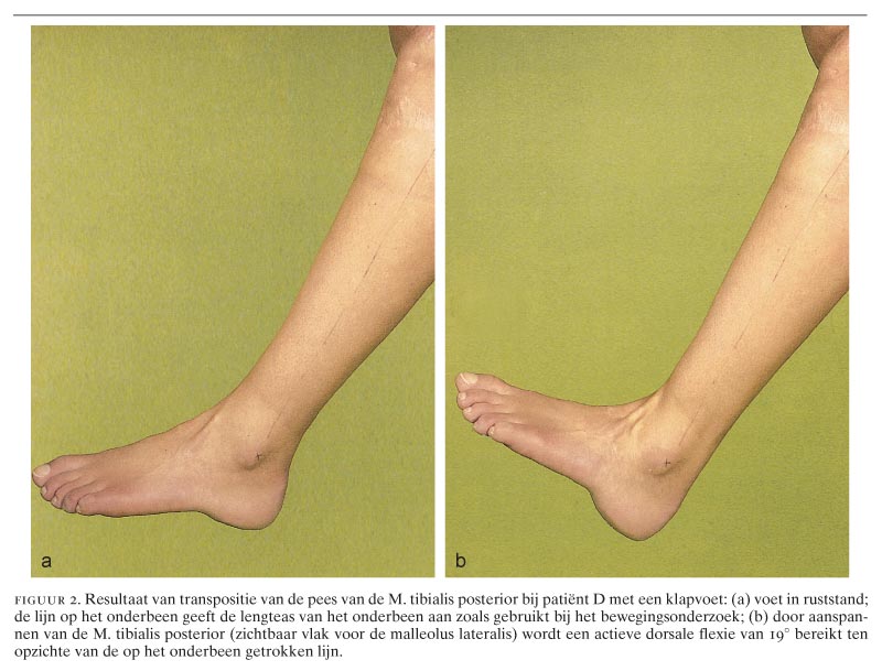 Transpositie van de pees van de M. tibialis posterior effectief bij een ...