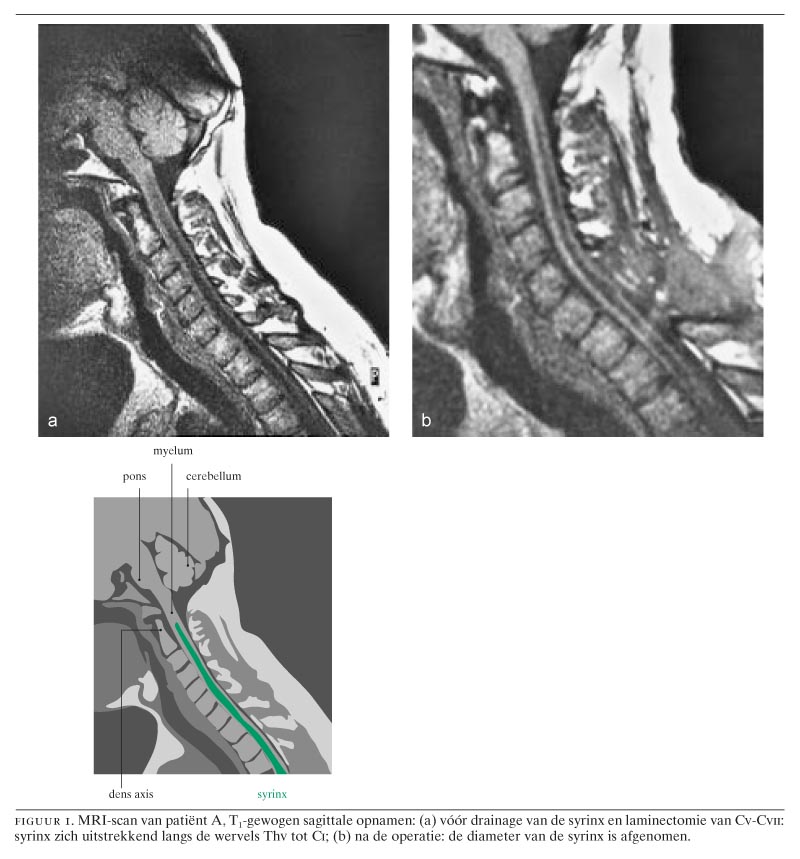 Posttraumatische syringomyelie bij 2 patiënten met een thoracale ...