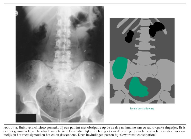 Fecale Impactie Obstipatie Door Schimmels Mestcel Activatie Syndroom