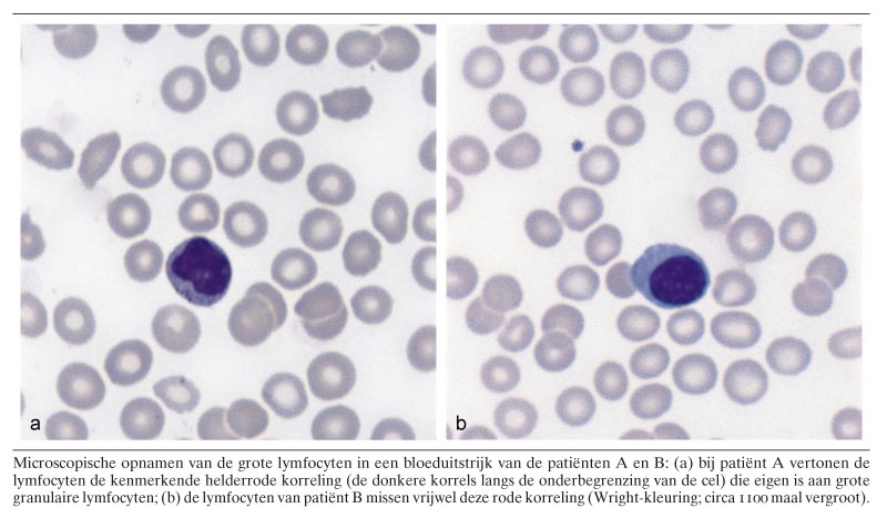 Twee patiënten met chronische lymfocytose van grote granulaire ...