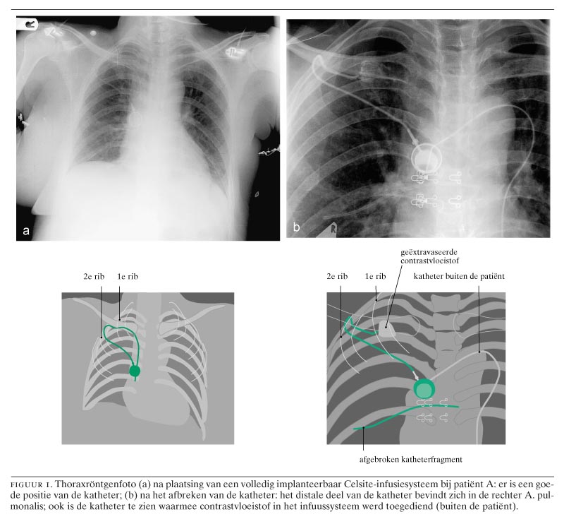 Katheterbreuk en -embolisatie: een zeldzame complicatie van een ...